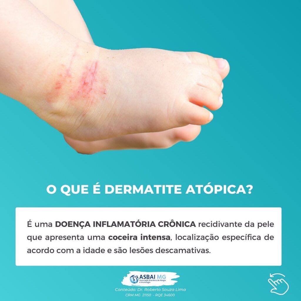 Dia da Conscientização da Dermatite Atópica - ASBAI MG